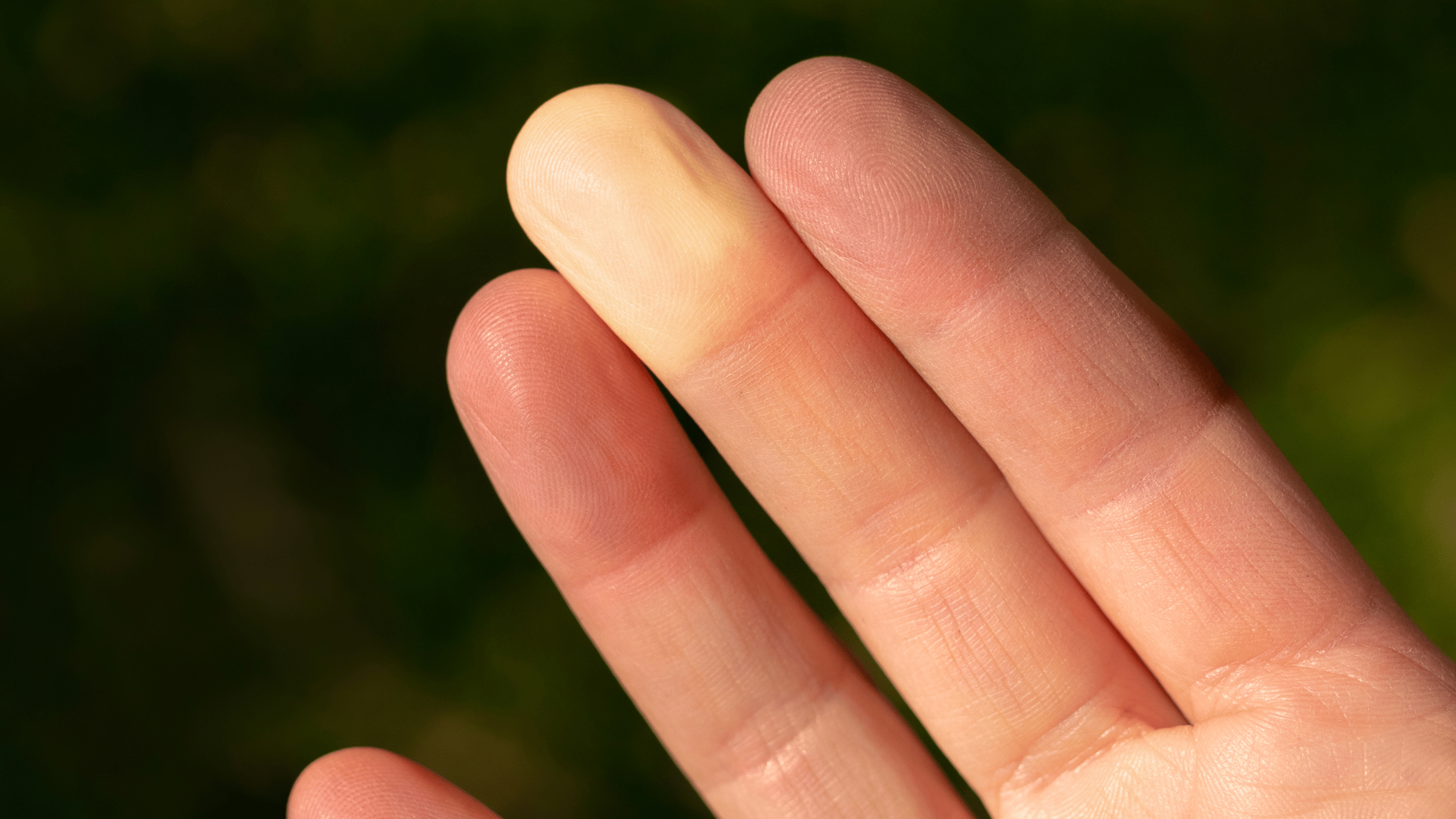 Understanding Hand-Arm Vibration Syndrome (HAVS): Frequently Asked ...